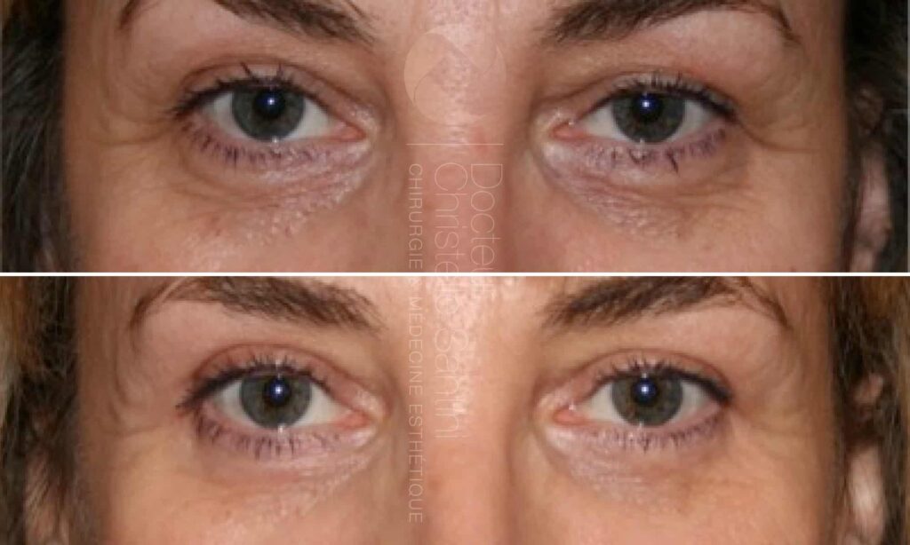 Blépharoplastie : Avant/Après | Dr Christelle Santini | Paris